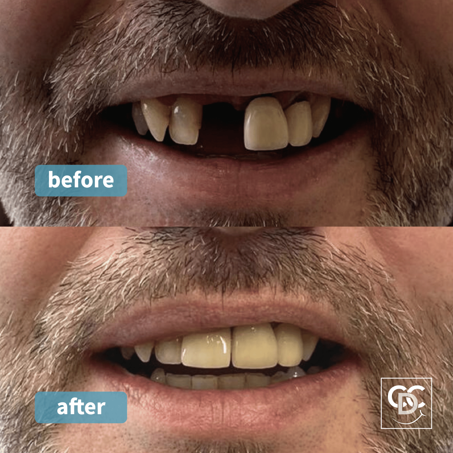 Coleshill Dental | Dental Implants in Birmingham Midlands